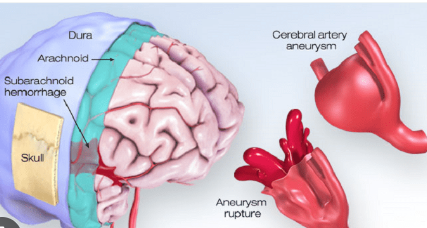 Differentiating the Types of Aneurysms: A Complete Understanding - Your ...